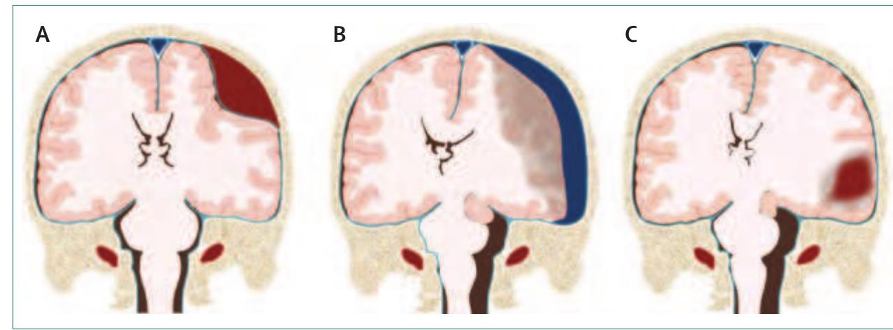 Different types of post-traumatic intracranial haematoma (a)