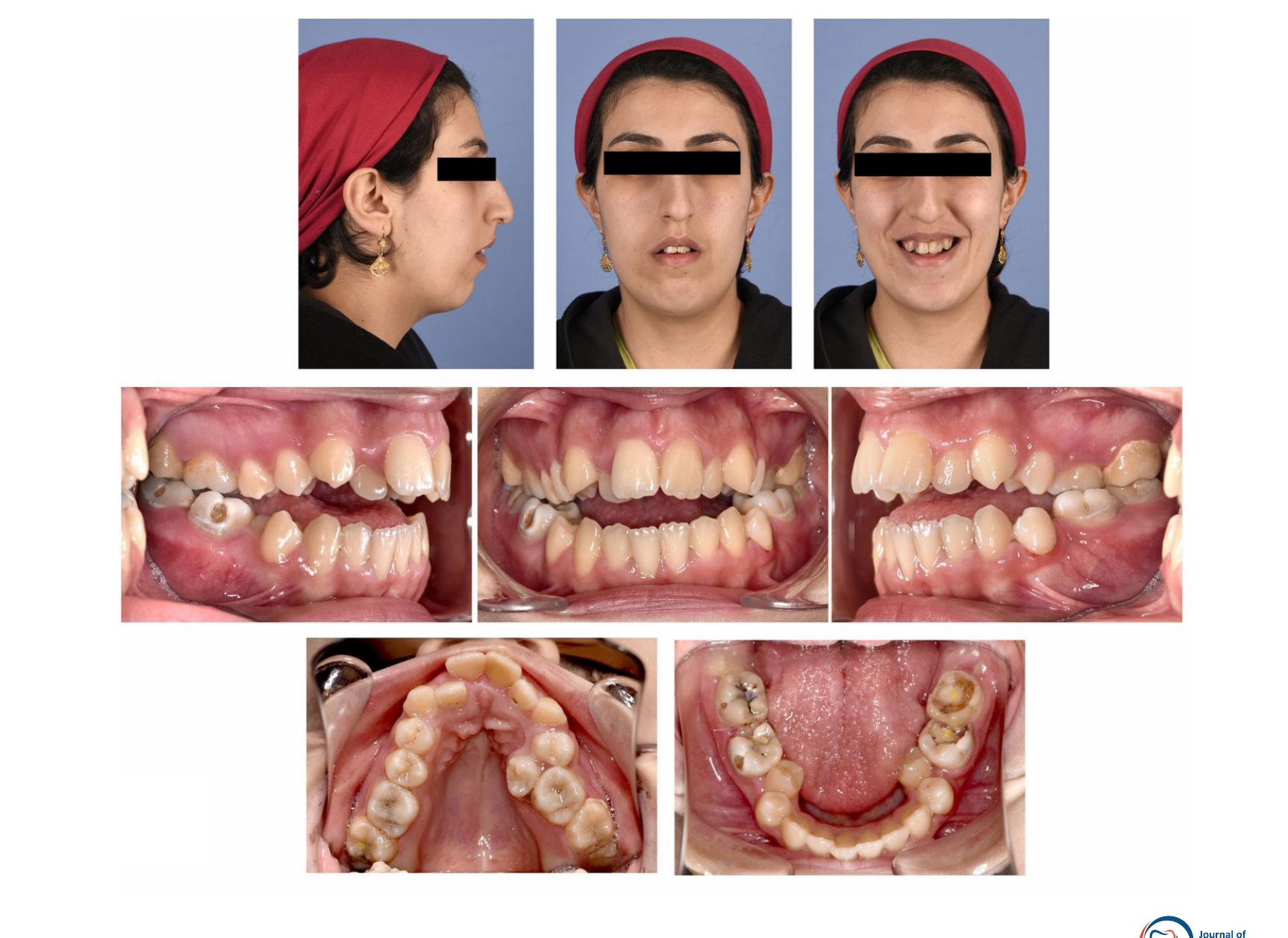 Pretreatment extraoral and intraoral photos after the