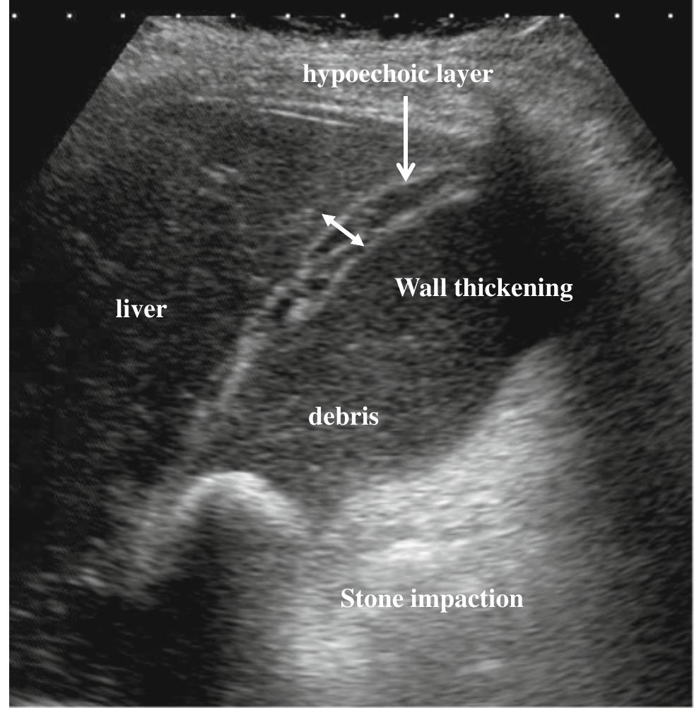 Us images of acute cholecystitis. gallbladder swelling, wall