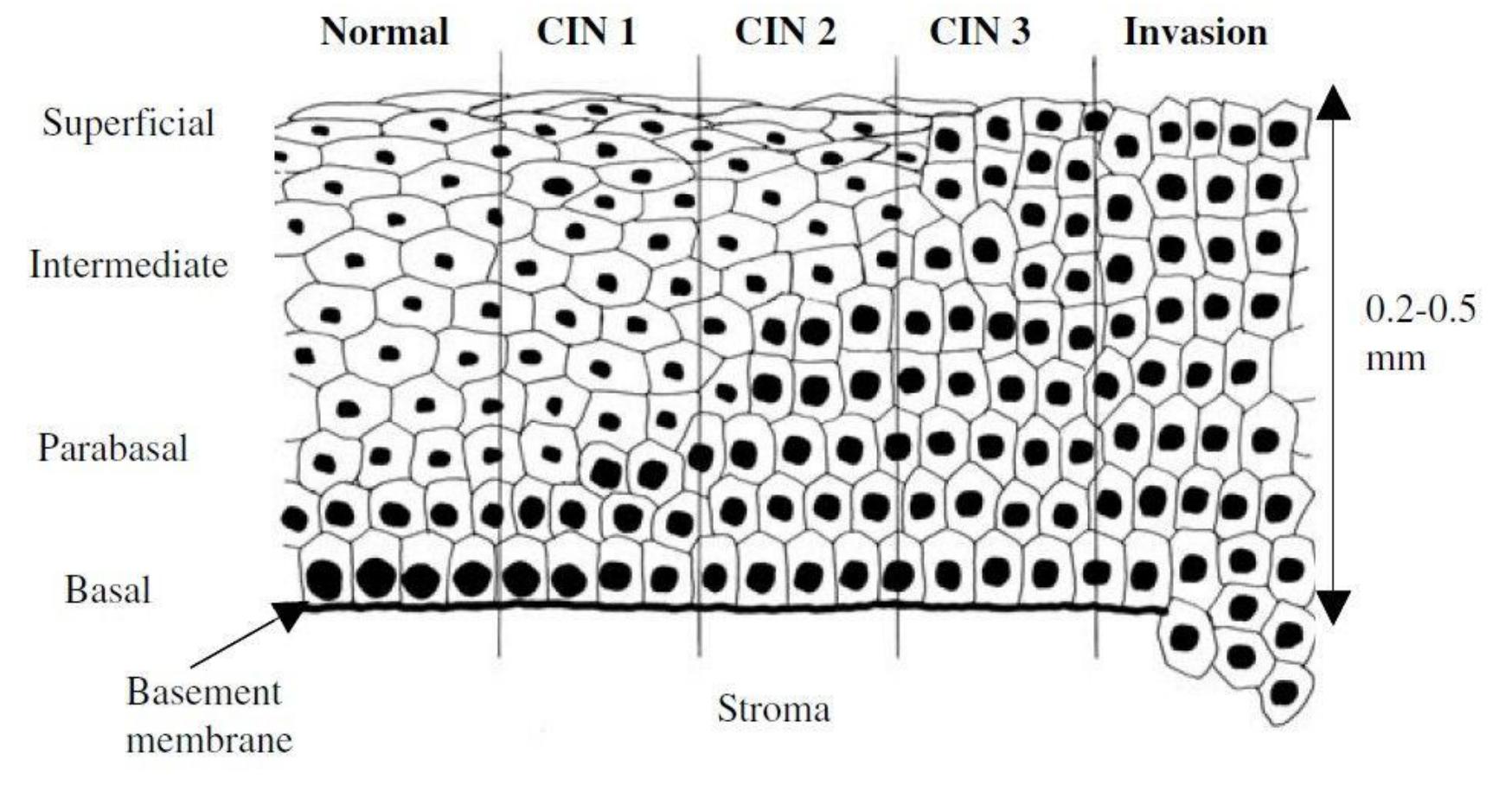 Progression of cervical intraepithelial neoplasia (cin) in