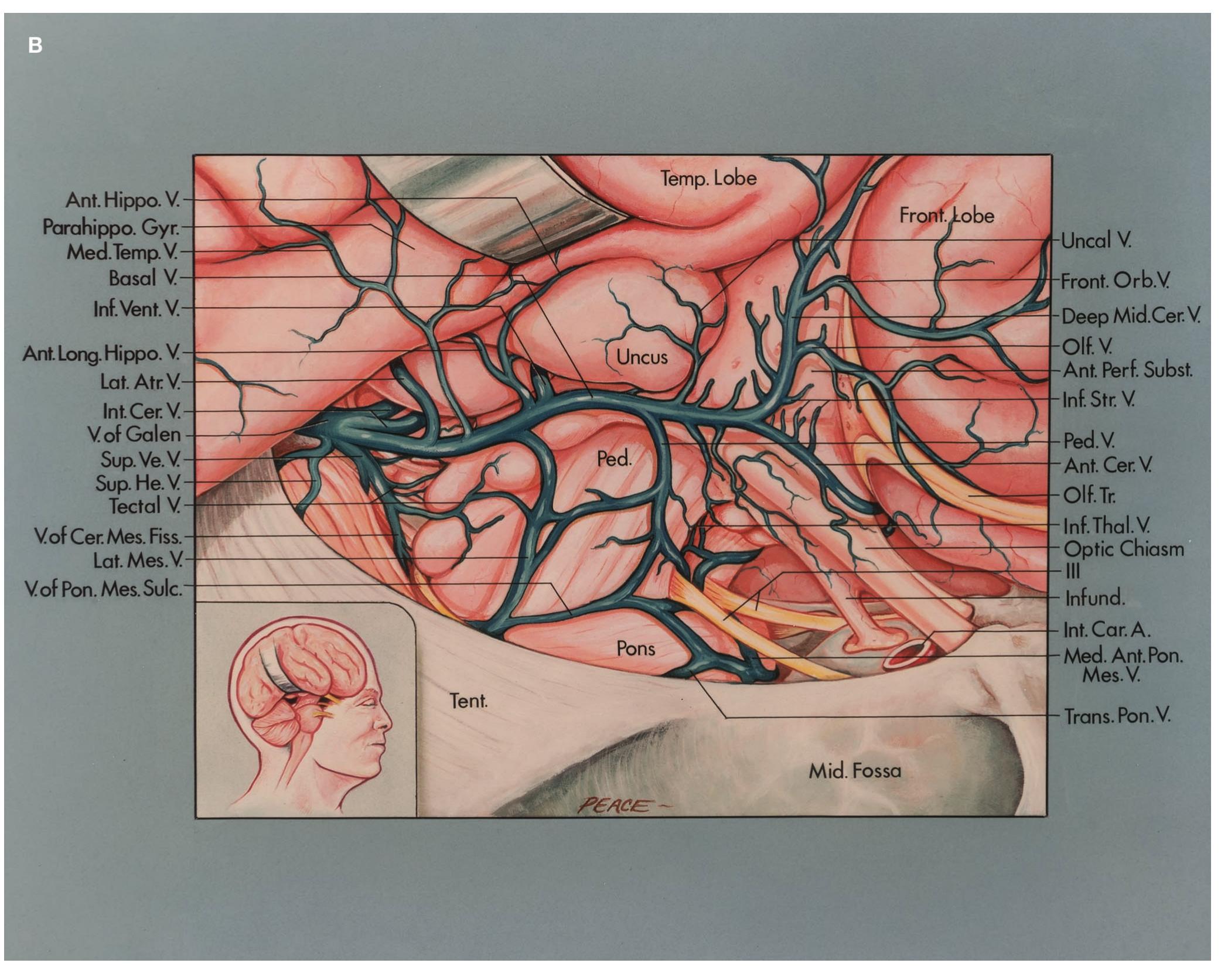 B, lateral view, right side. the temporal lobe has been