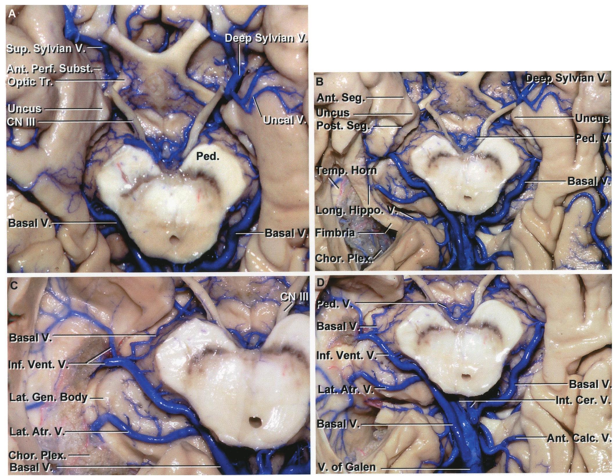 20. inferior viecw of the basal cisterns. a, the basal veins