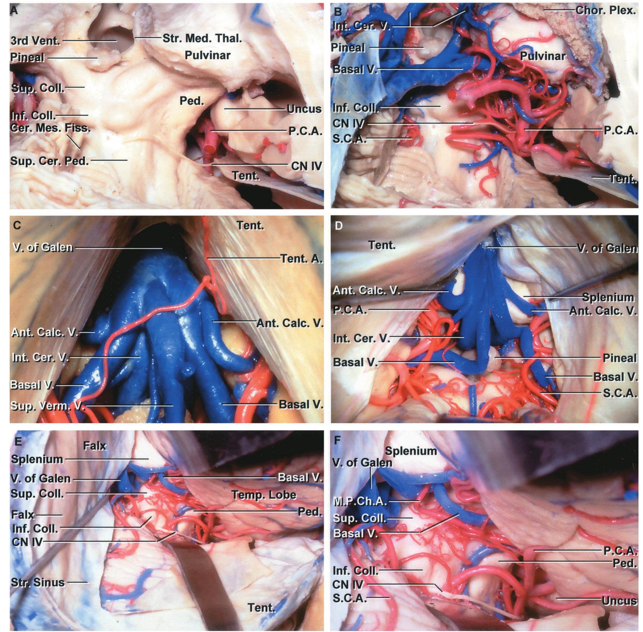 24. venous relationships in the quadrigeminal cistern. a,