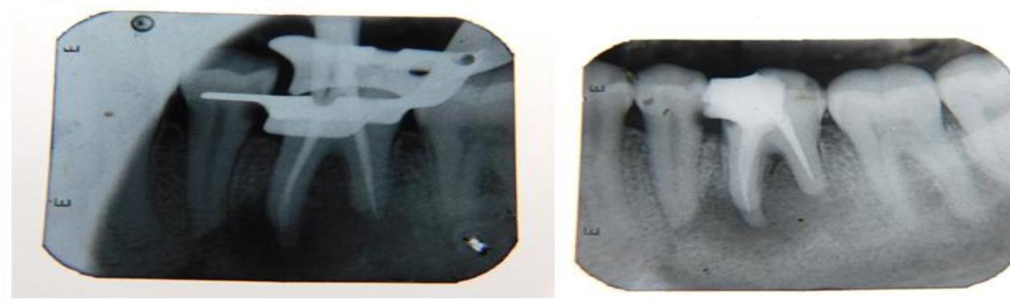Obturation done fig. 13: master cone radiograph apices were