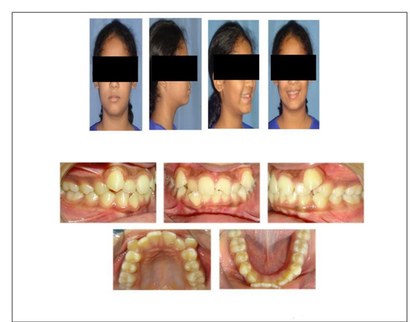 (PDF) Molar Distalization with Modified Pendulum Appliance in Treatment ...