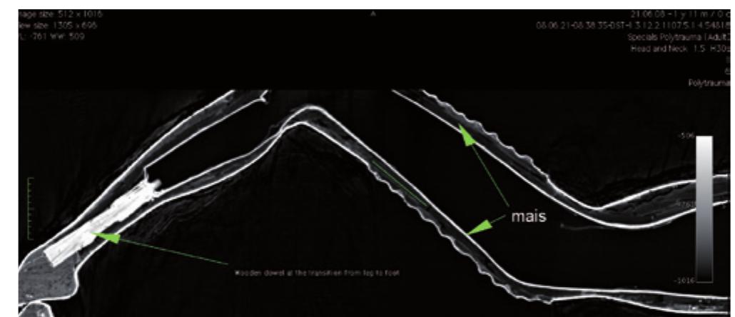 Ct scan, axial cut through one leg fig. 11: ct scan, cross