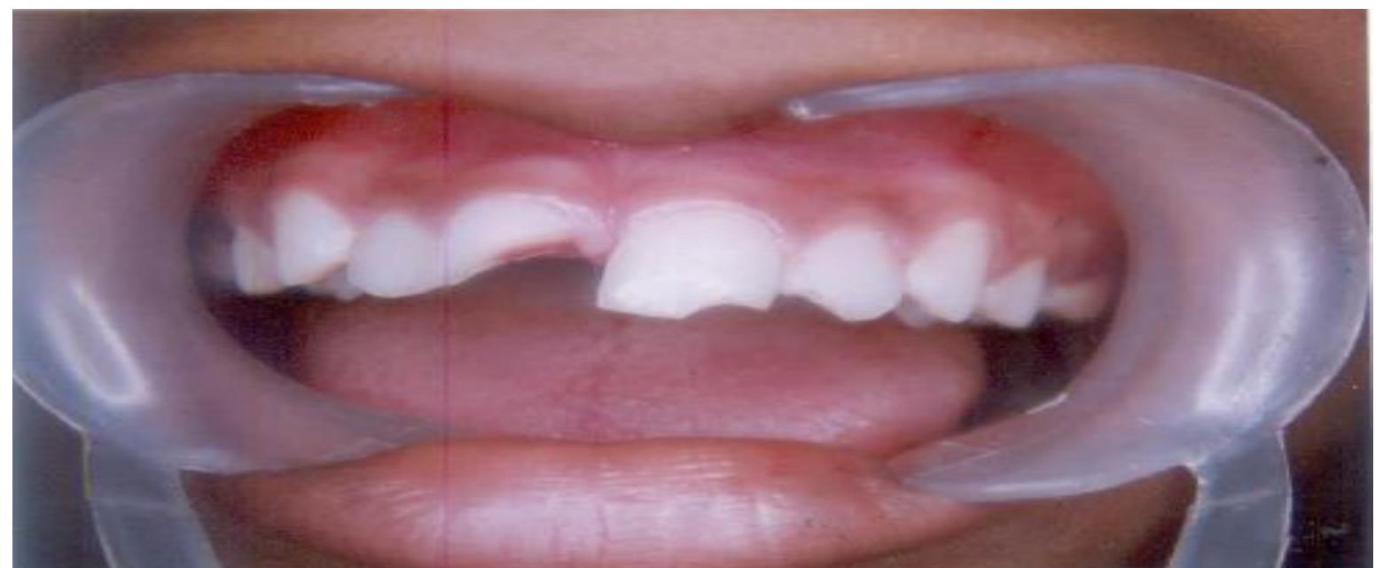 A photograph showing elli’s and davey’s type iii fracture in