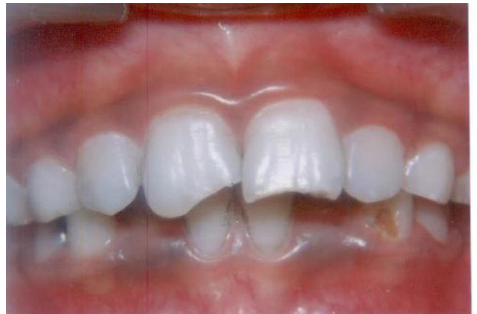 A photograph showing elli’s and davey’s type ii fracture in