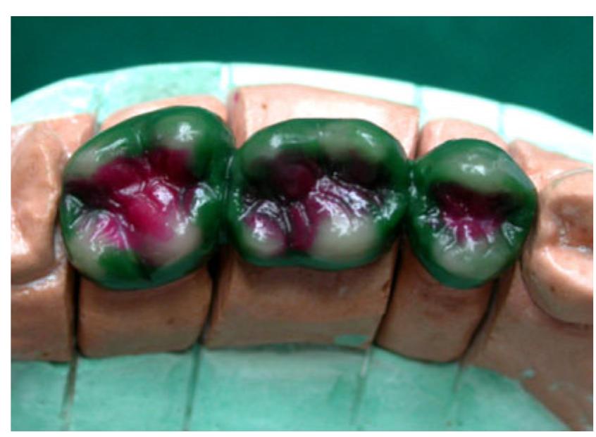 Occlusal morphology of the wax pattern