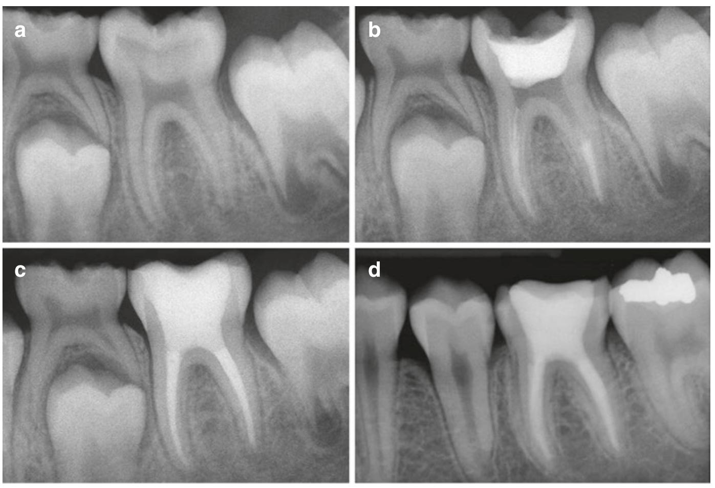 15 (a) preoperative radiograph of mandibular right first