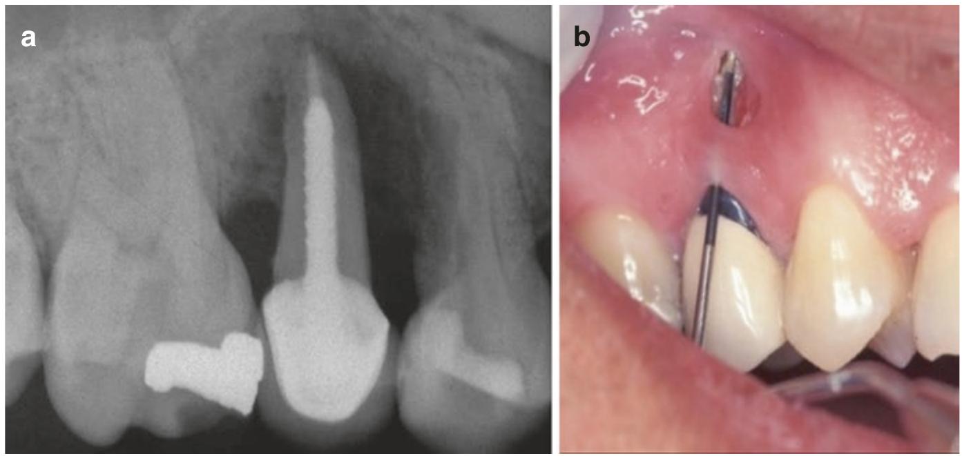 17 (a) periapical radiograph of maxillary right second