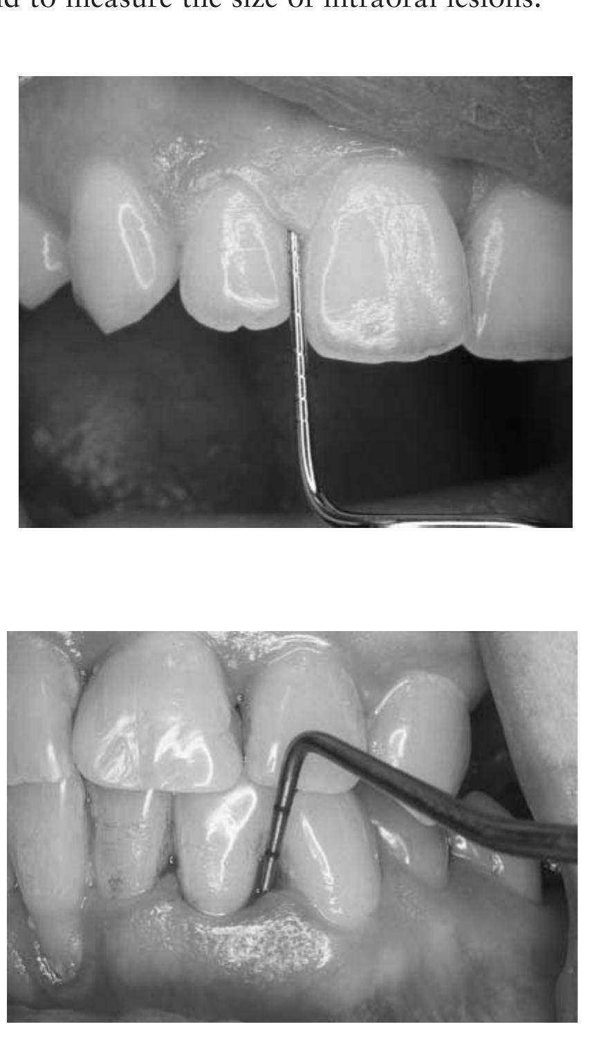 (PDF) Calibrated Periodontal Probes and Basic Probing Technique