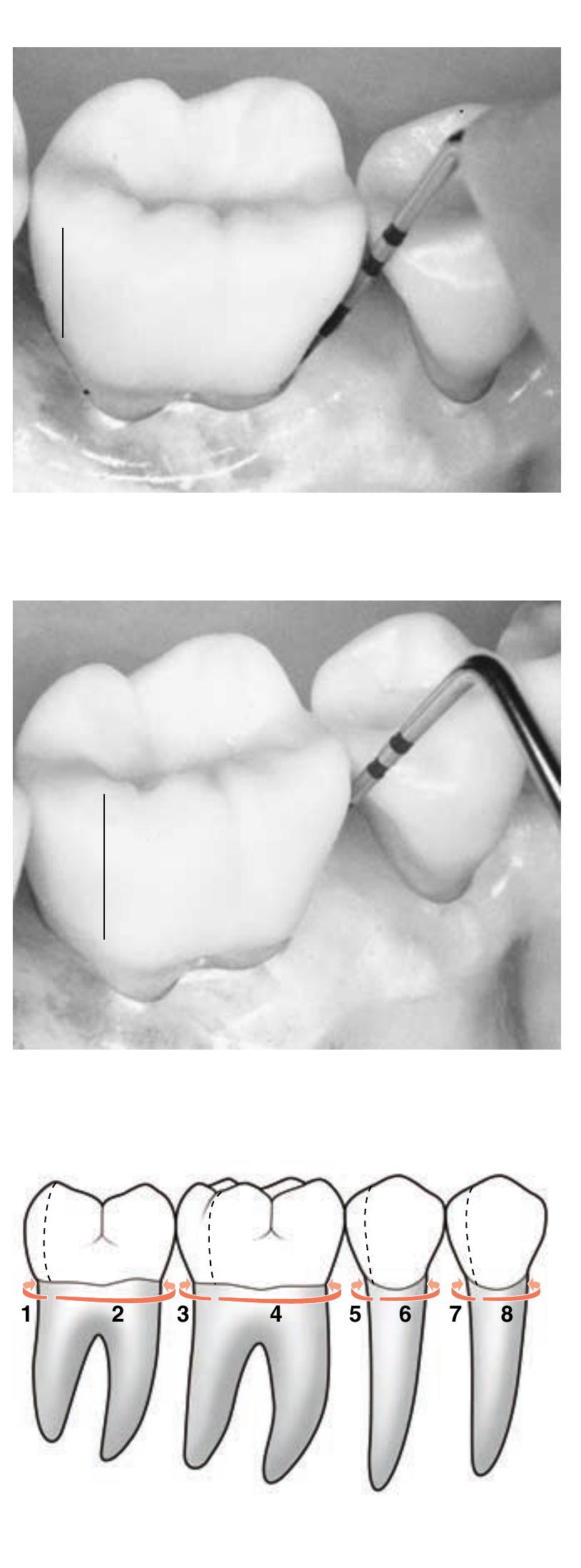 Figure 22 - Calibrated Periodontal Probes and Basic Probing