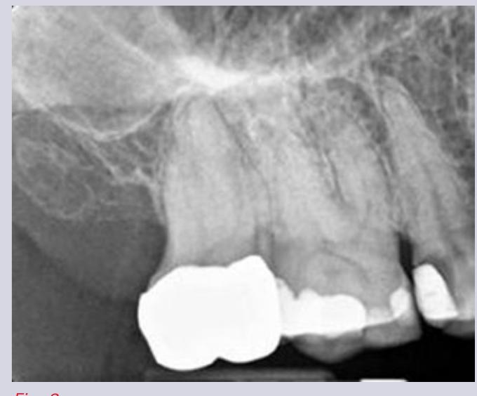 Maxillary left first molar has occlusal-mesial caries and