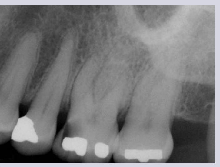 Mandibular right lateral incisor has an apical radiolucency