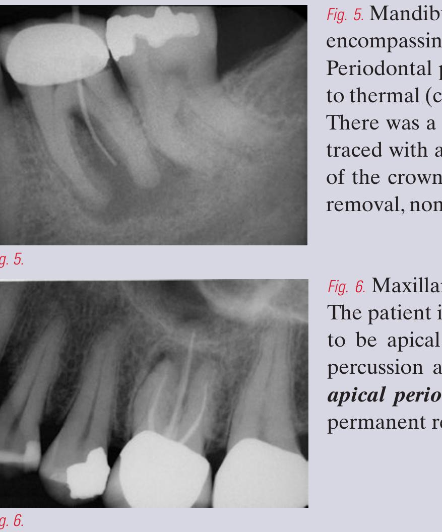 , maxillary left lateral incisor exhibits an apical