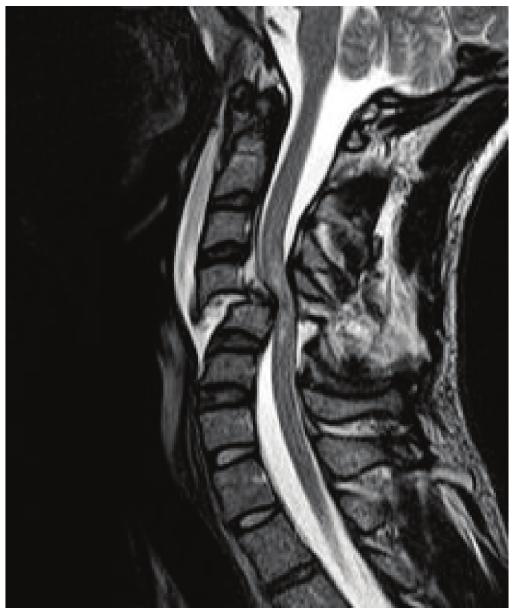 Cervical spine mri of a patient with sci: c4 fracture and