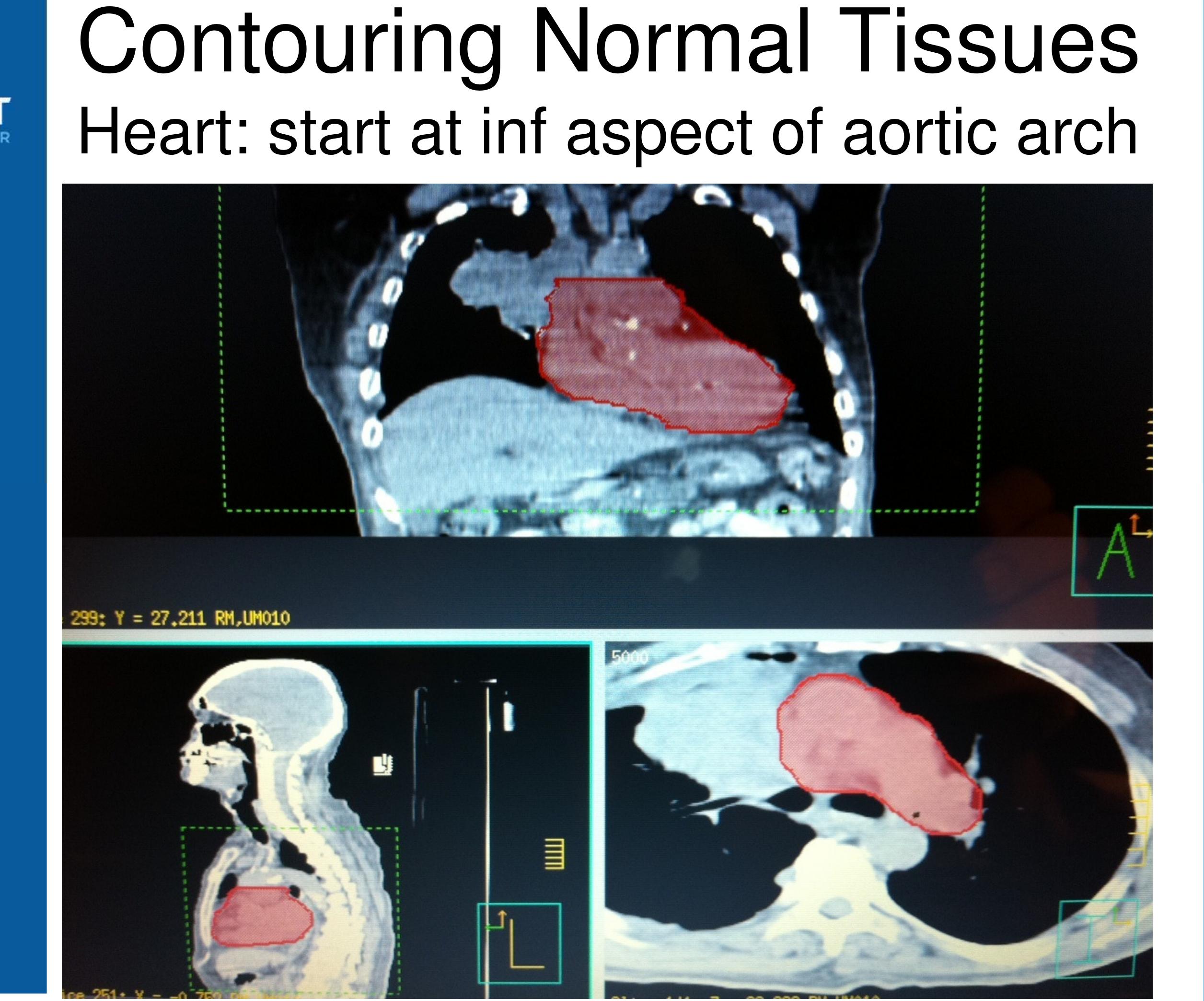 Figure 51 - A Review Of QUANTEC Normal Tissue Tolerances