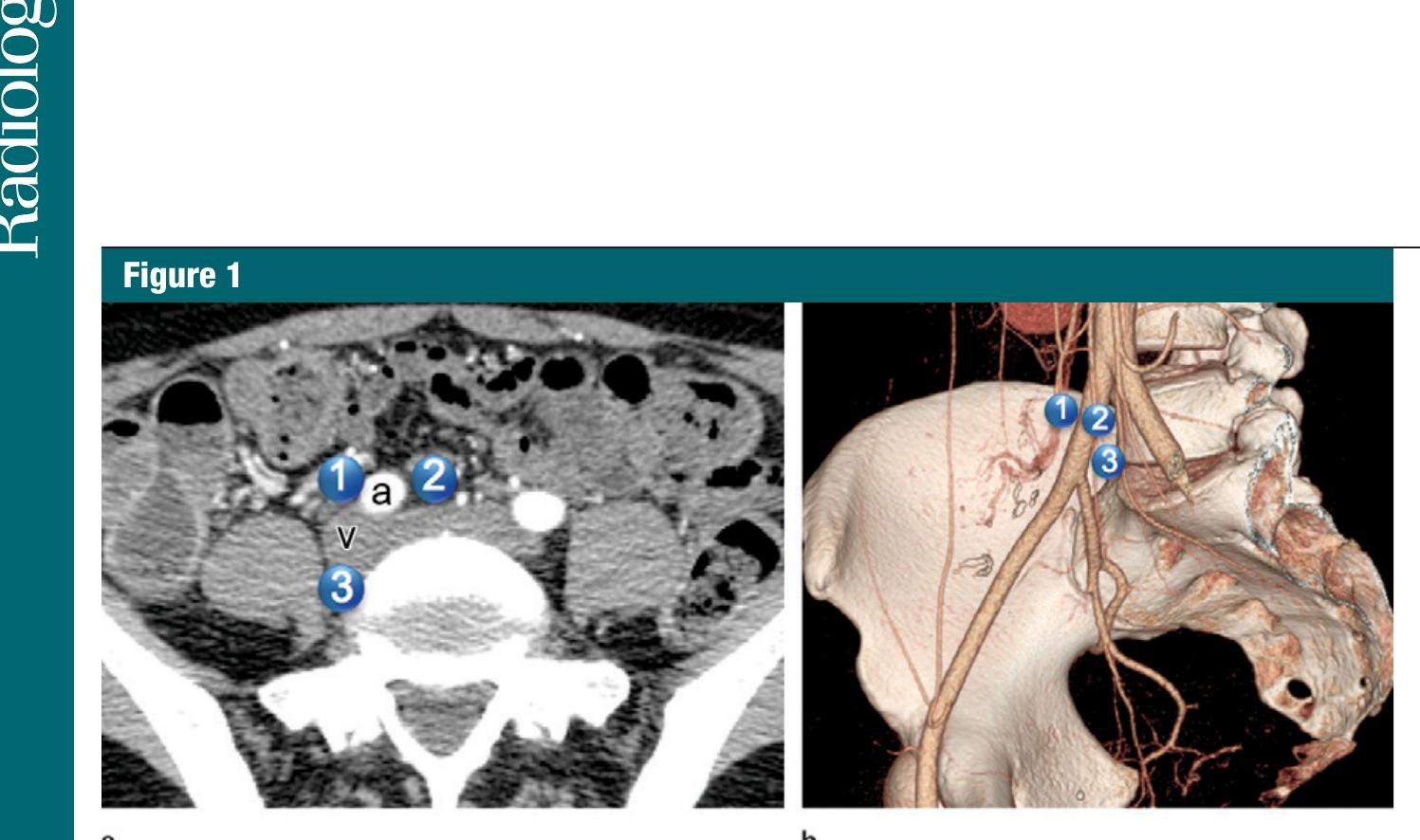 Common iliac lymph nodes. (a) axial contrast