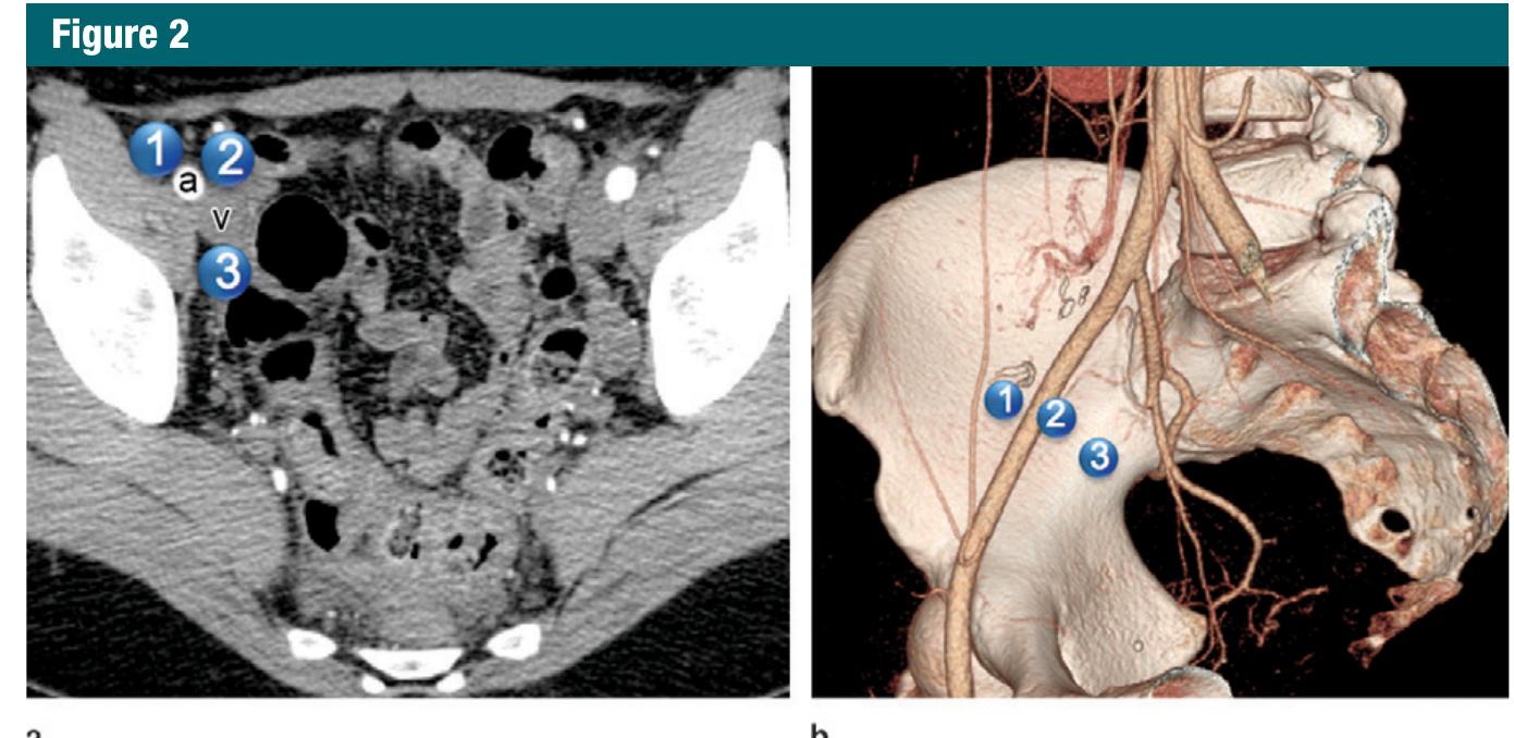 External iliac lymph nodes. (a) axial contrast-enhanced ct