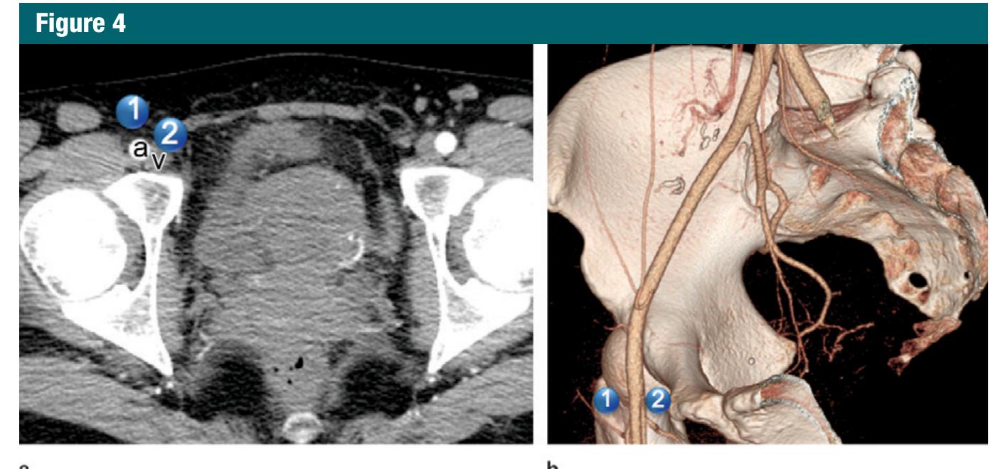 Inguinal lymph nodes. (a) axial contrast-enhanced ct image