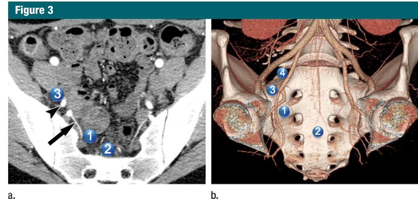 Internal iliac lymph nodes. (a) axial contrast-enhanced ct