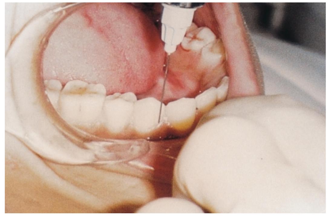 Intraligamentary injection.