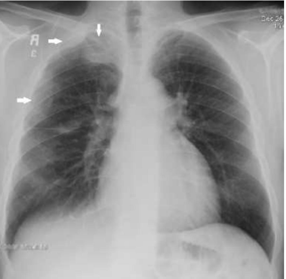 Chest radiograph (cxr) of a 50-year-old male who presented