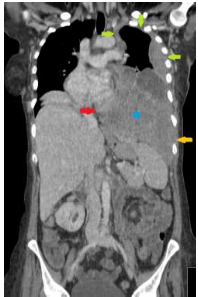 Coronal reformat from staging ct scan of a 70-year-old