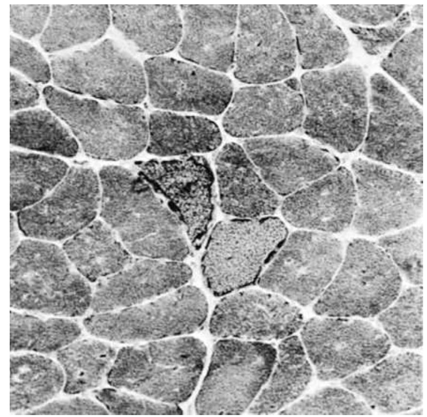-3 ragged-red fibers (trichrome stain). the mitochondria are