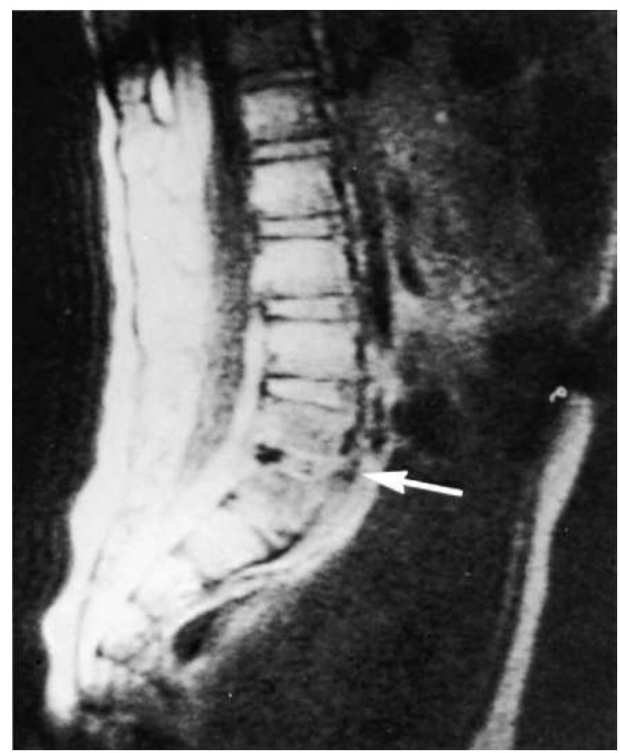 -2 diskitis. mri reveals collapse of the disk space (arrow)