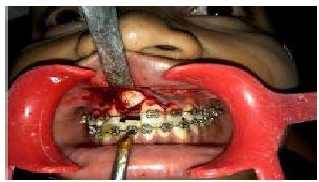 A buccally placed anterior tooth (fig 8) fig.8 — surgical