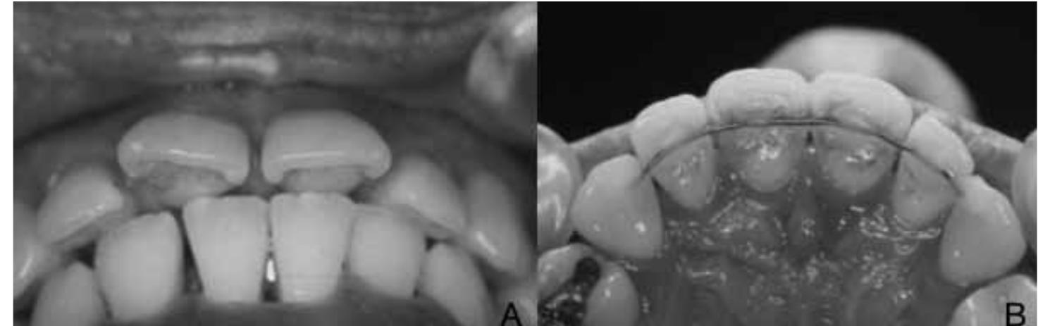(a) maxillary midline diastema; (b) lingual retainer