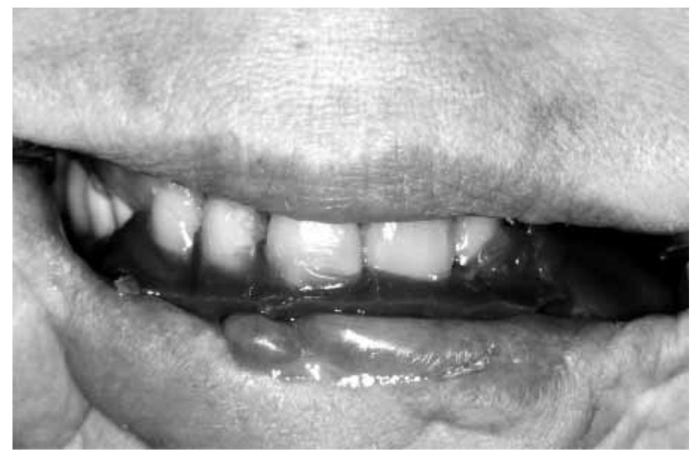 A. intraoral view of the mandibular wire supported silicone