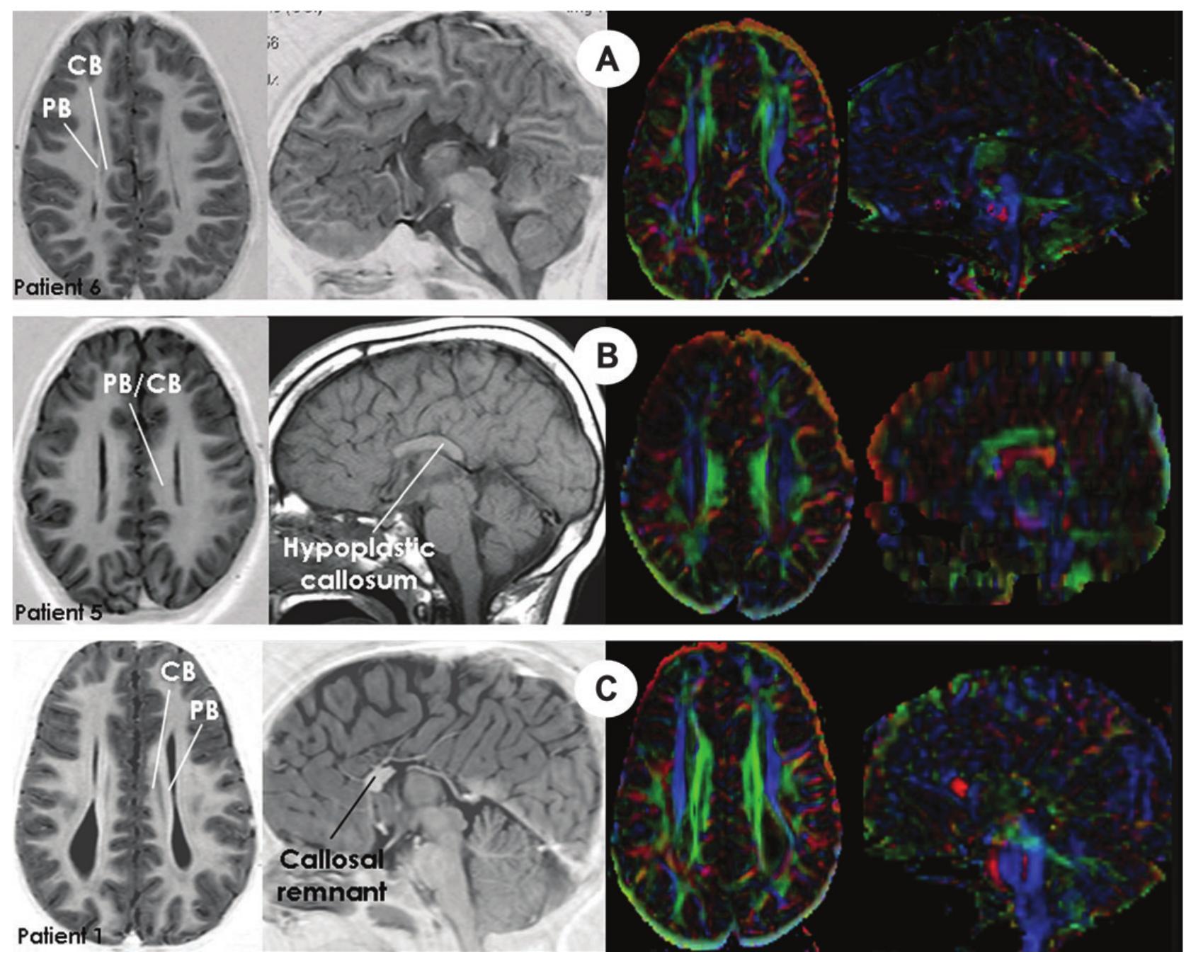 Types Of Cd 7 Weighted Images And Color Coded Fa Maps