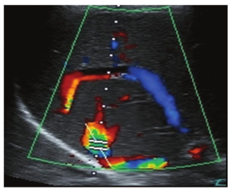 Right lobe of liver with doppler gate (sample volume] at rhv
