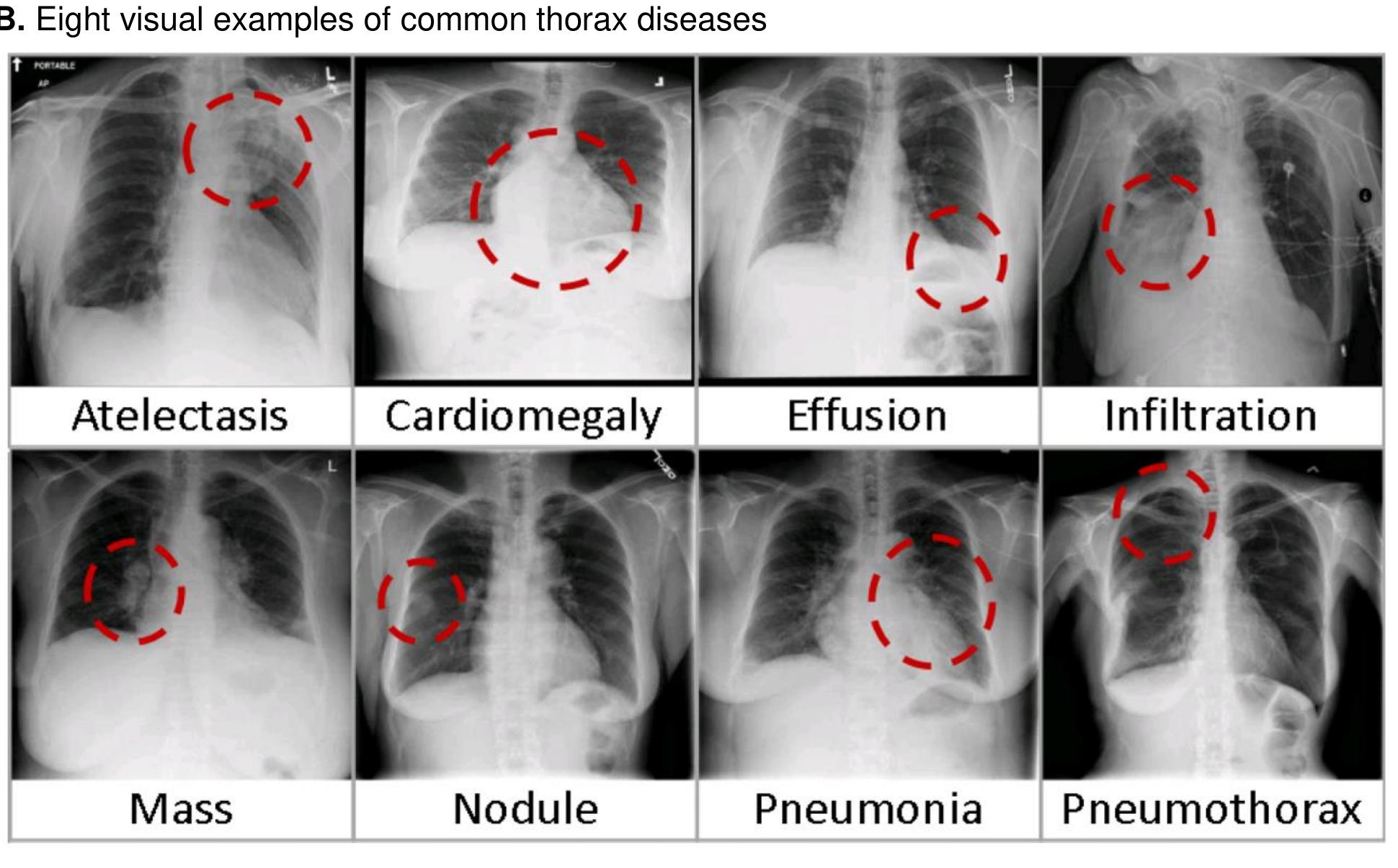 Figure 2 - NIH Chest X-ray Dataset of 14 Common Thorax