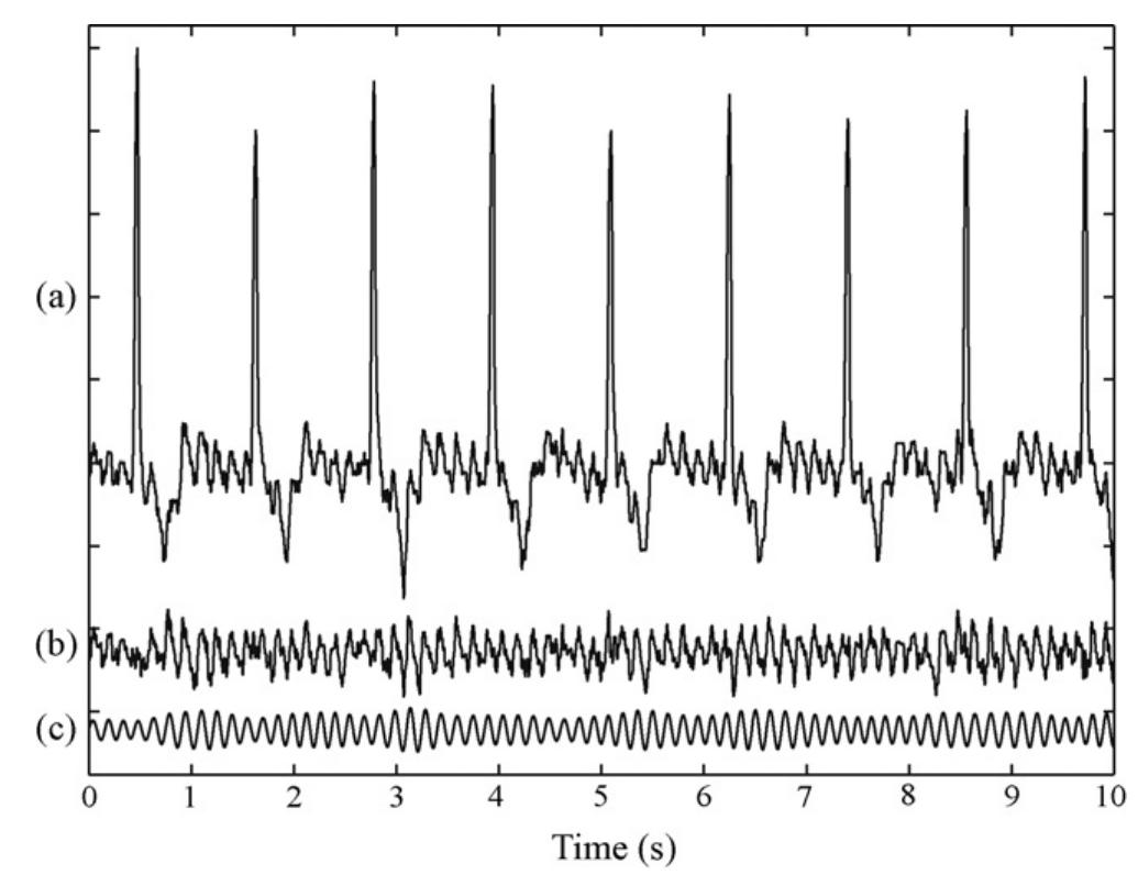 a) example of a 10s-length ecg segment with paroxysmal