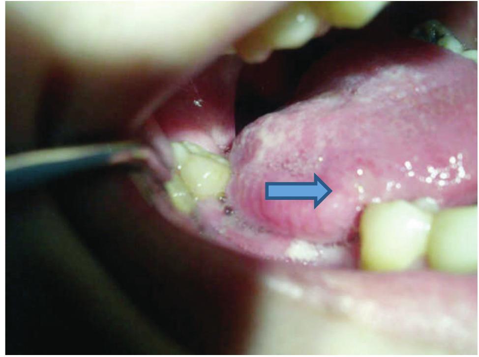 ‘igure 6. the wound post extraction of tooth 45 was still