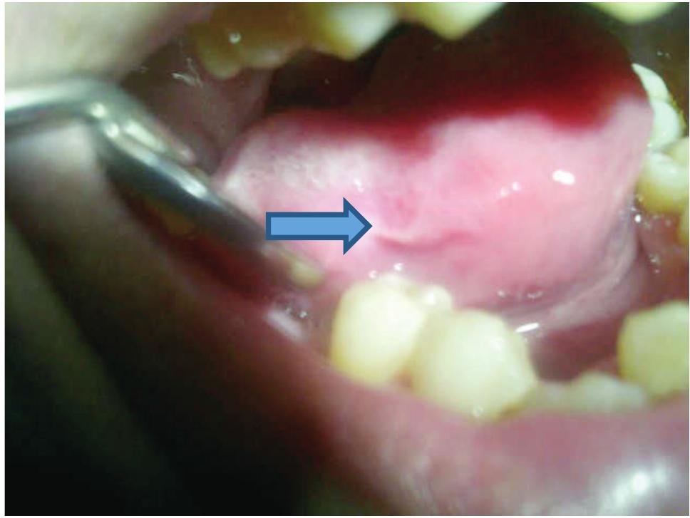 Figure 6 - from The management of chronic traumatic ulcer in