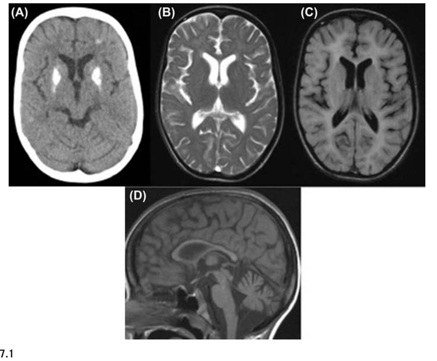 Brain ct scan (a), axial t2-weighted mri (b), axial flair Brain ct scan (a), axial t2-weighted mri (b), axial flair