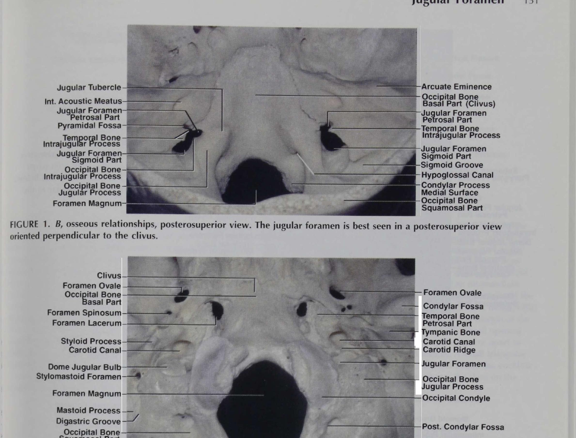 Figure 3 - The Jugular Foramen: Microsurgical Anatomy and