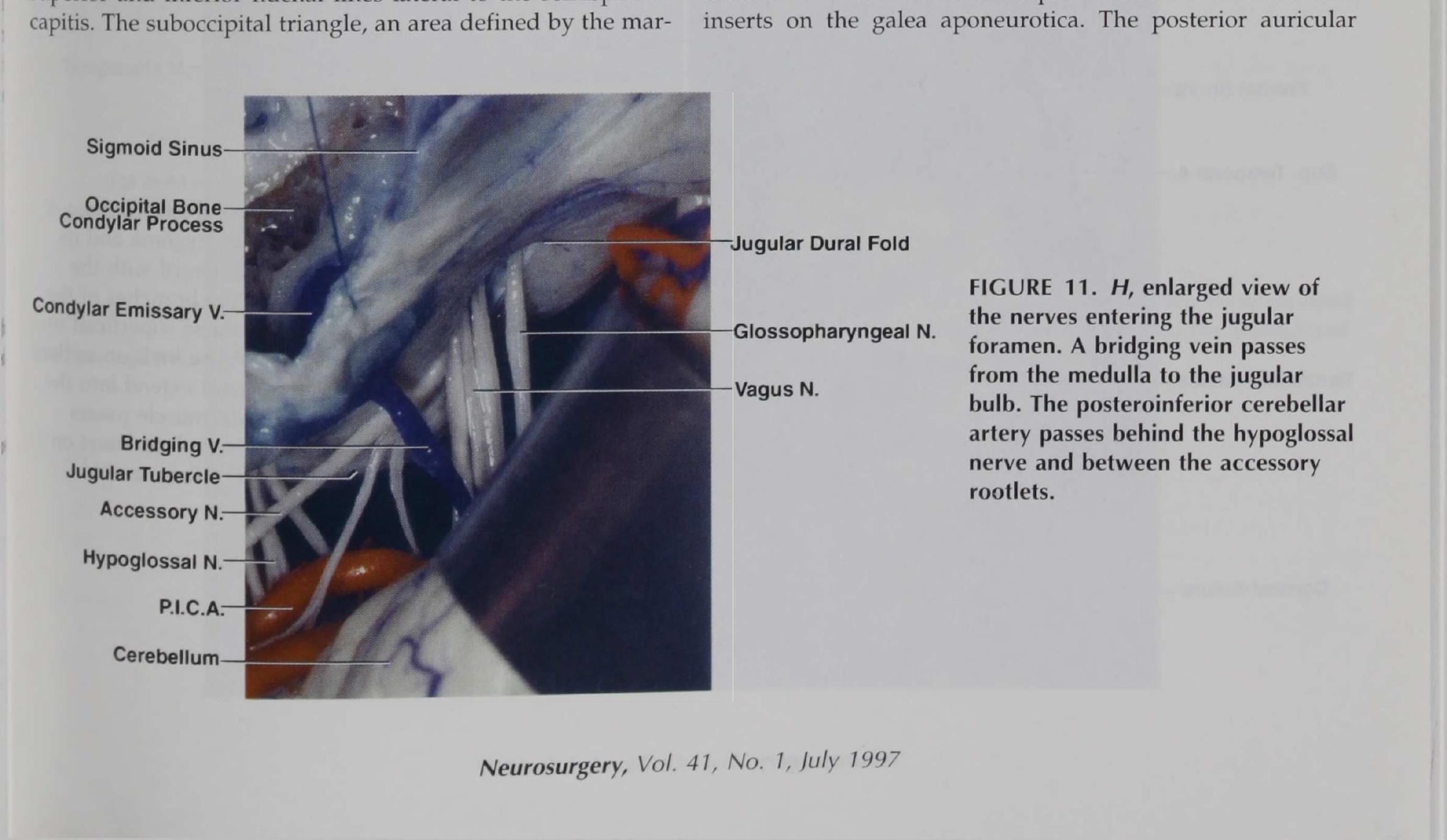 Figure 53 - The Jugular Foramen: Microsurgical Anatomy and