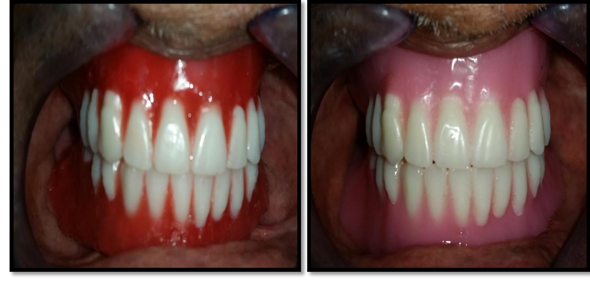 Figure 6 - COMPLETE DENTURE WITH METAL DENTURE BASE: A CASE