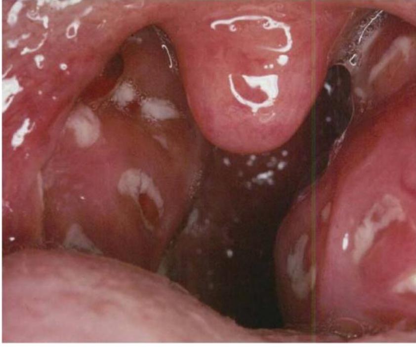 #6: enlarged adenoids & tonsils