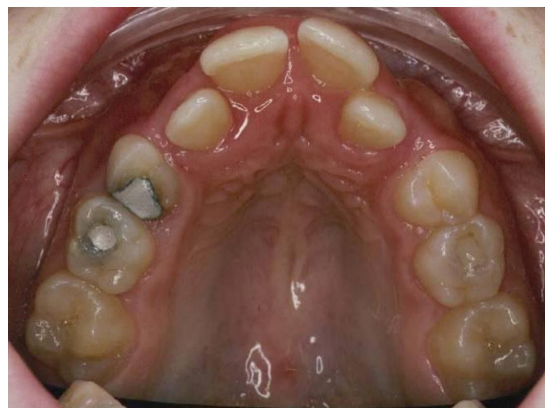 #10: “v” shaped palate