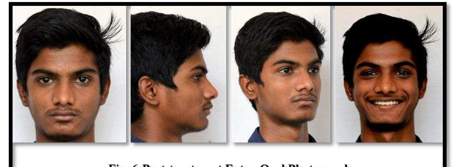 Ar” ee —— ee the facial aesthetic was improved with better