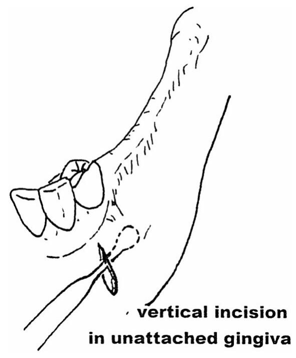 Ficure 16. a vertical incision is made in the mandibular