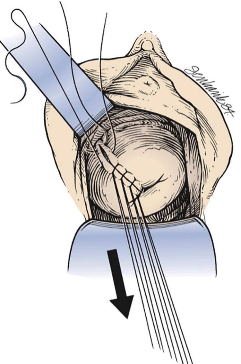 Cervical laceration repair. the cervical laceration repair