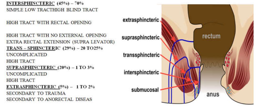 Figure 1 - from DISTAL LASER PROXIMAL SLOFT (DLPS)